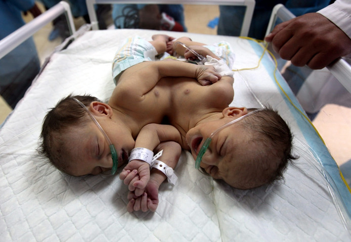 Pasgeboren Siamese tweeling deelt één lichaam | Buitenland | AD.nl