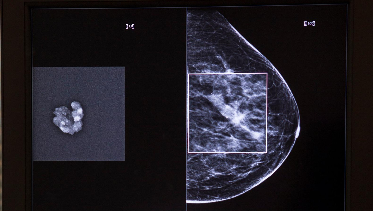 Borstkanker vaak niet herkend | Het Parool