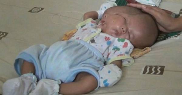 Half ontwikkelde Siamese tweeling heeft twee gezichten op één hoofd ...