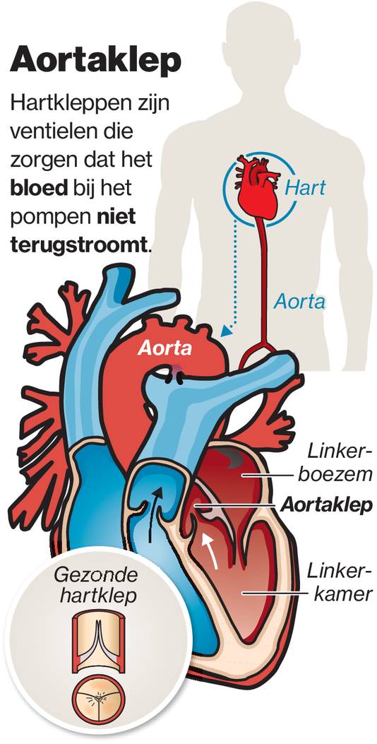 Een nieuwe hartklep kan voortaan via de lies naar het hart | Gezond ...