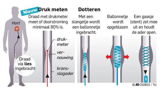 Minder sterfgevallen door 't nieuwe dotteren | Binnenland | AD.nl