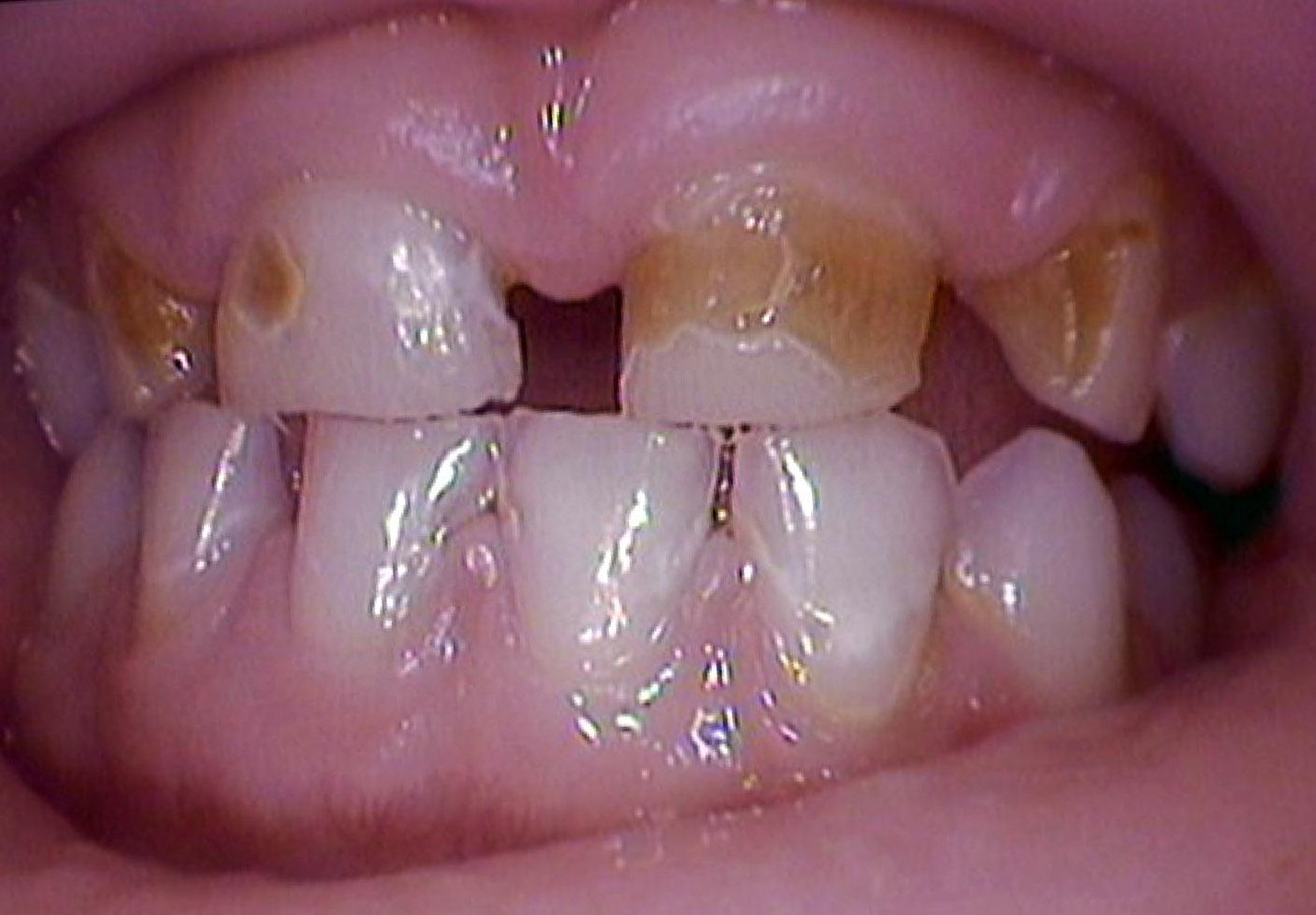 Tienergebitten zien er steeds slechter uit | Foto | AD.nl